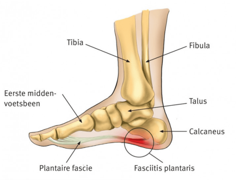 Wat is een peesplaatontsteking en hoe het beste te behandelen? - kPNI ...